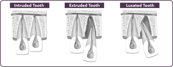 How to Manage a Dental Accident - Clinique DMD