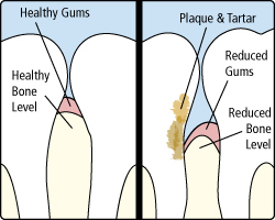 What is Periodontitis? - Clinique DMD